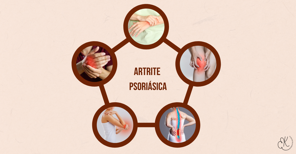 Artrite Psoriática: o que você precisa saber