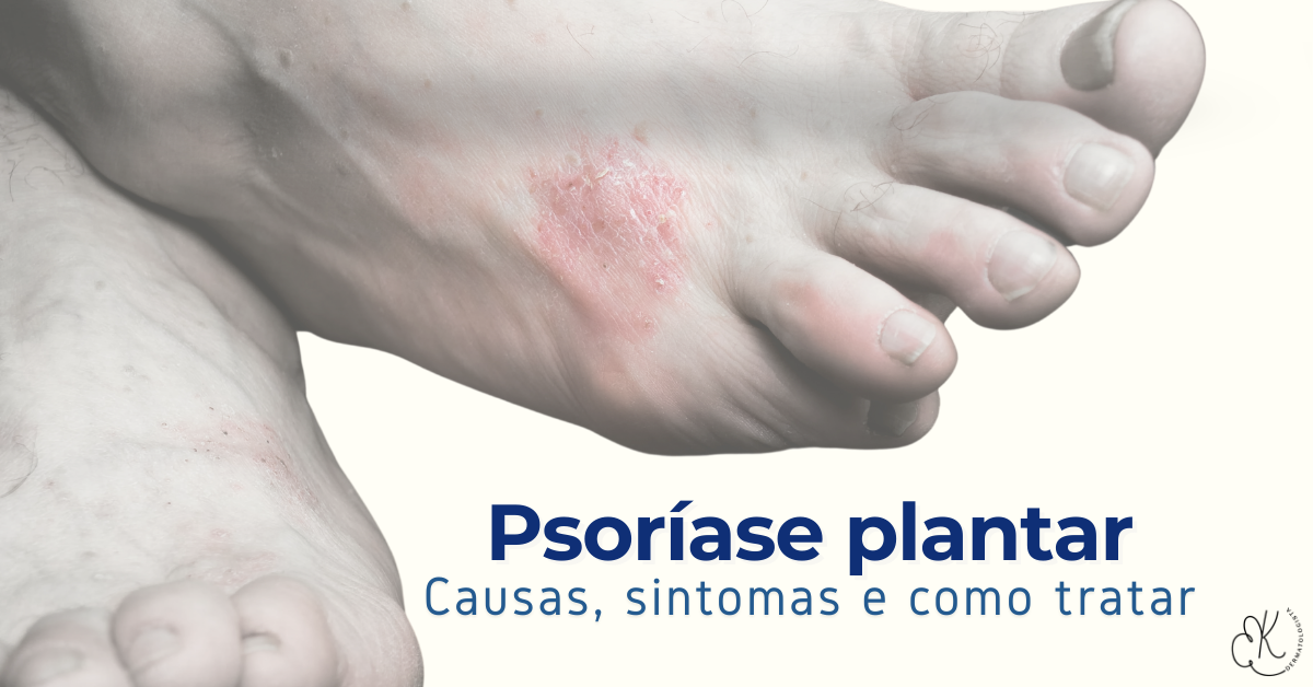 Psoríase Plantar: Sintomas, Causas e Tratamentos Eficazes