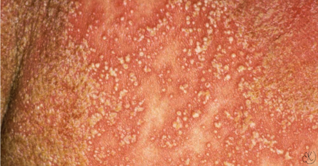 Tipos de Psoríase: Sintomas, diagnóstico e tratamentos