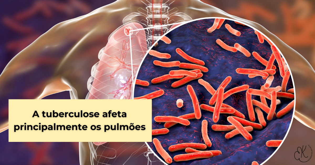 Psoríase e Tuberculose: Riscos e Cuidados no Tratamento